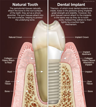 Get Dental Implants and Rejuvenate Your Smile in Spokane, WA!